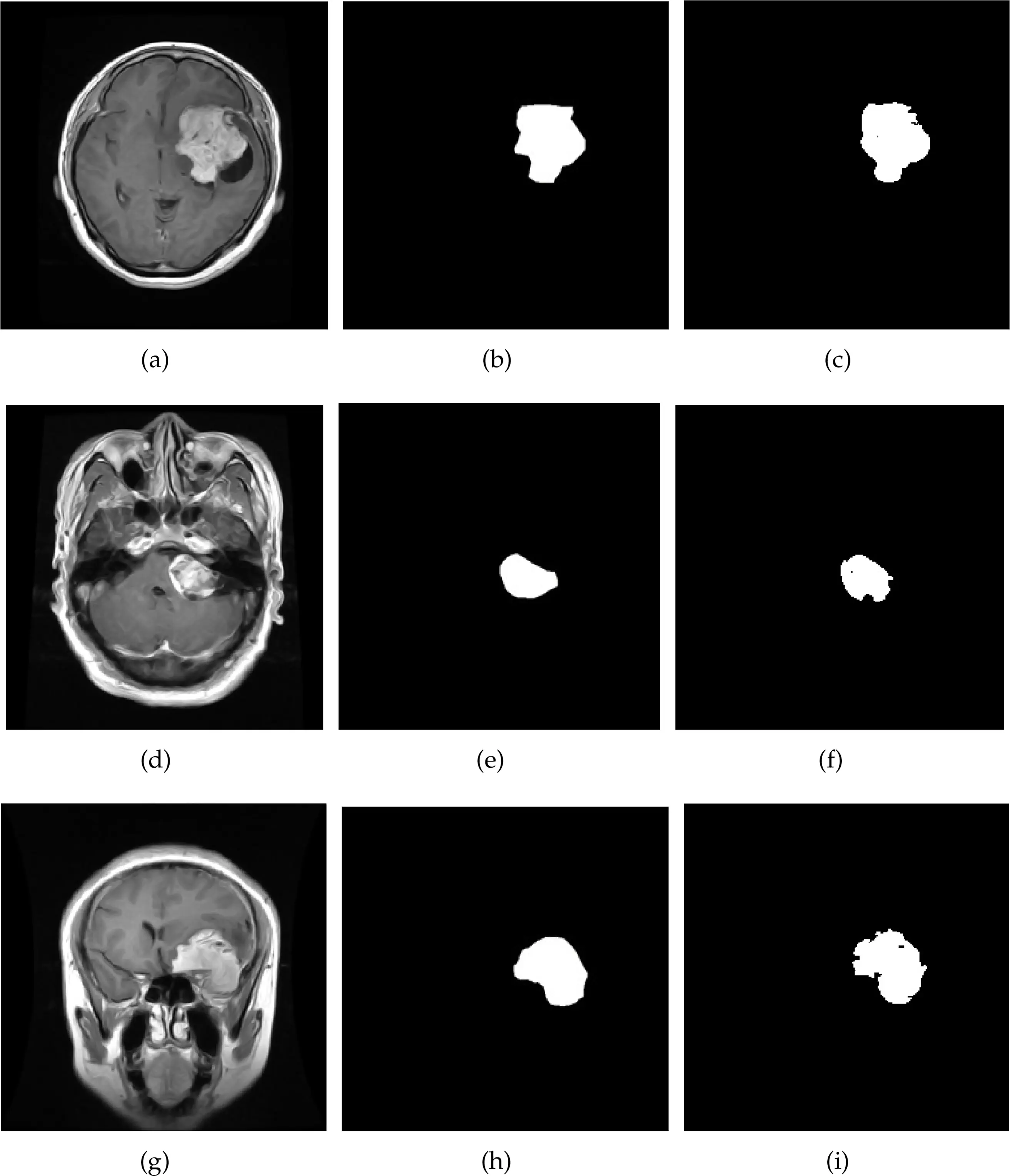 CMES | Free Full-Text | Advanced Computational Modeling for Brain Tumor ...