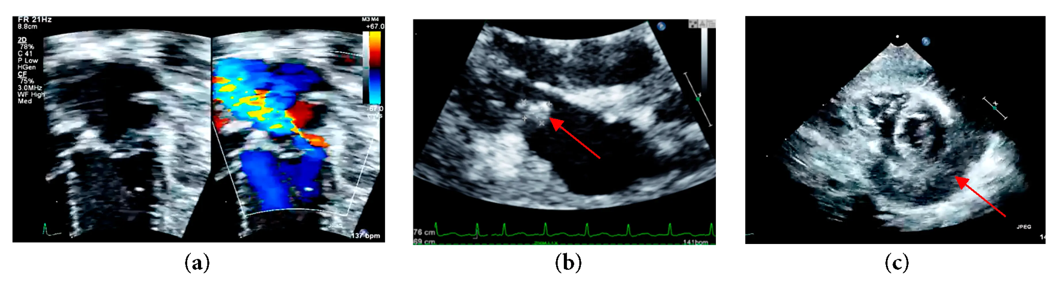 CHD | Free Full-Text | Case Report: A Rare Case of Left Atrial Aneurysm ...