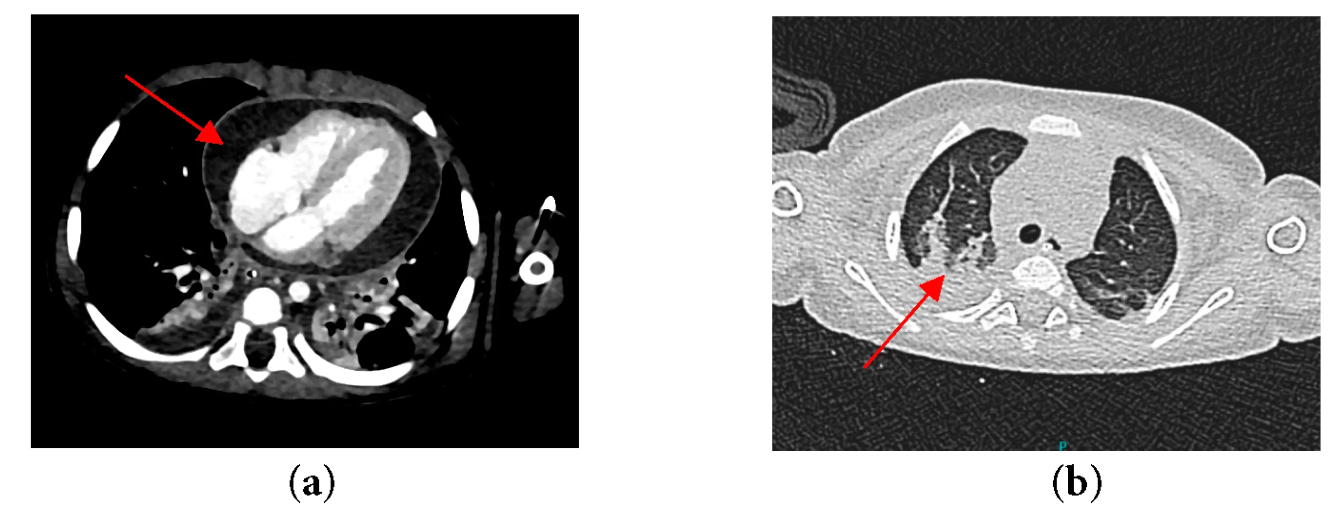 CHD | Free Full-Text | Case Report: A Rare Case of Left Atrial Aneurysm ...