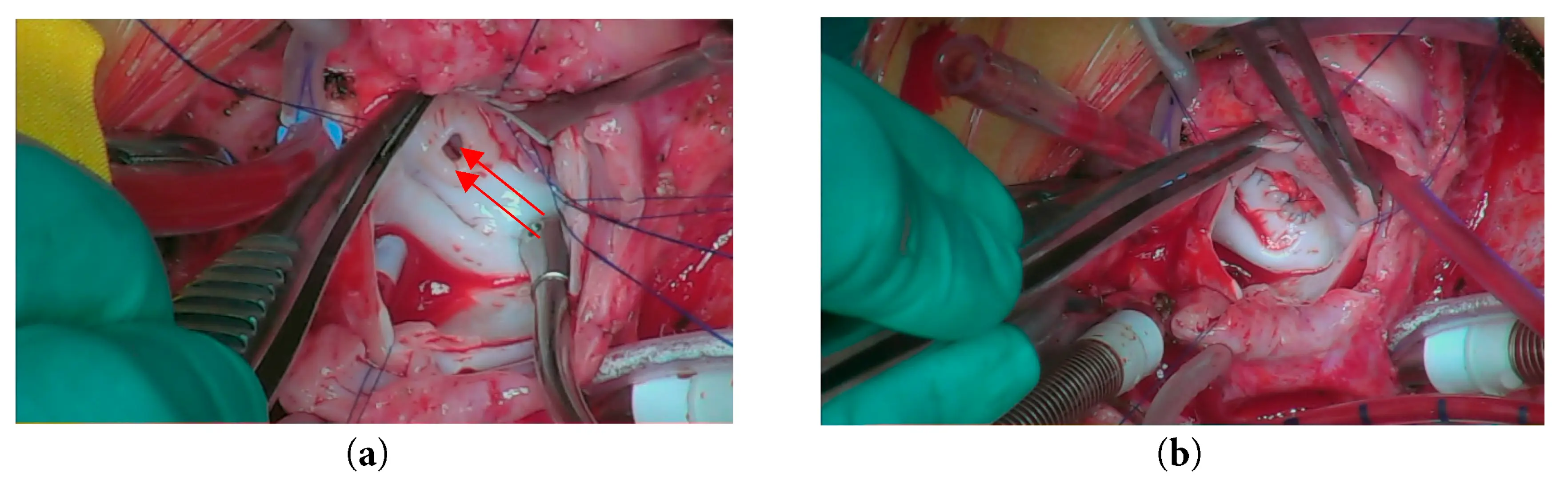 CHD | Free Full-Text | Case Report: A Rare Case of Left Atrial Aneurysm ...
