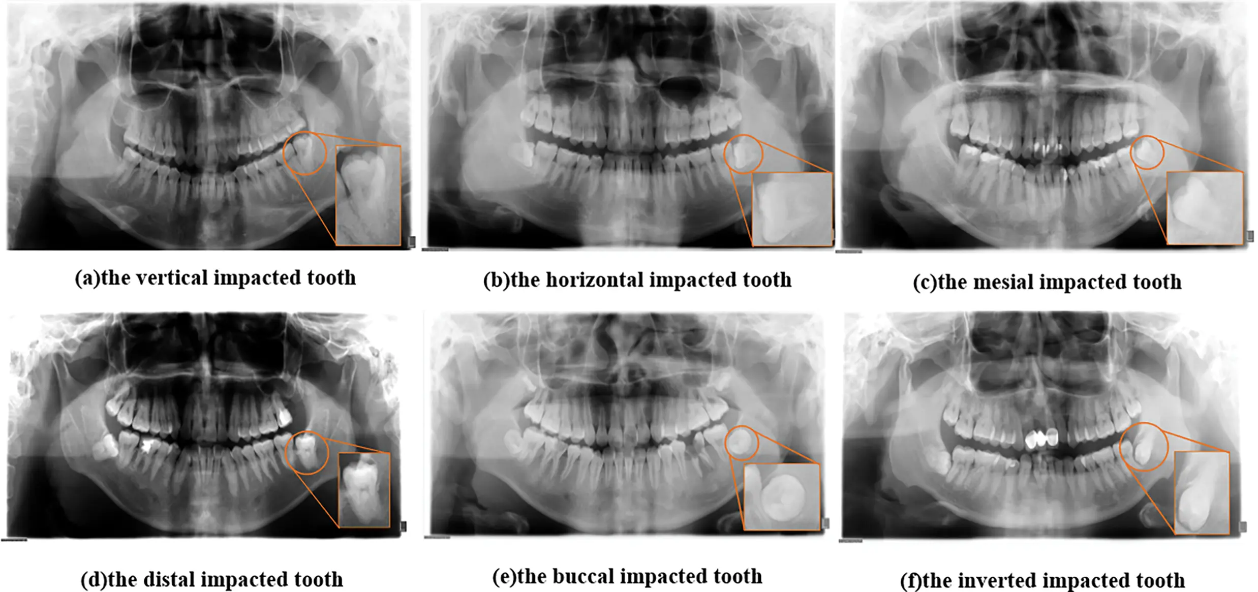 CMC | Free Full-Text | Teeth YOLACT: An Instance Segmentation Model Based on Impacted Tooth ...