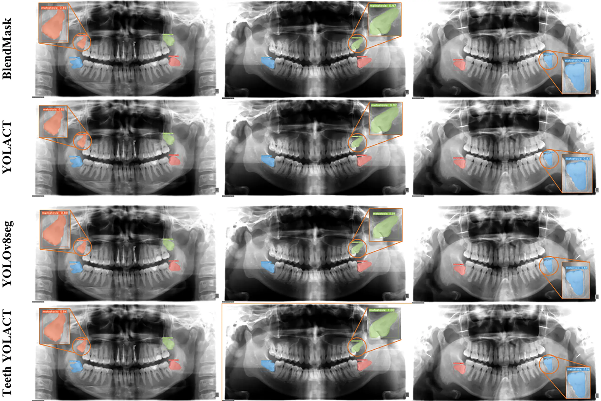 CMC | Free Full-Text | Teeth YOLACT: An Instance Segmentation Model Based on Impacted Tooth ...