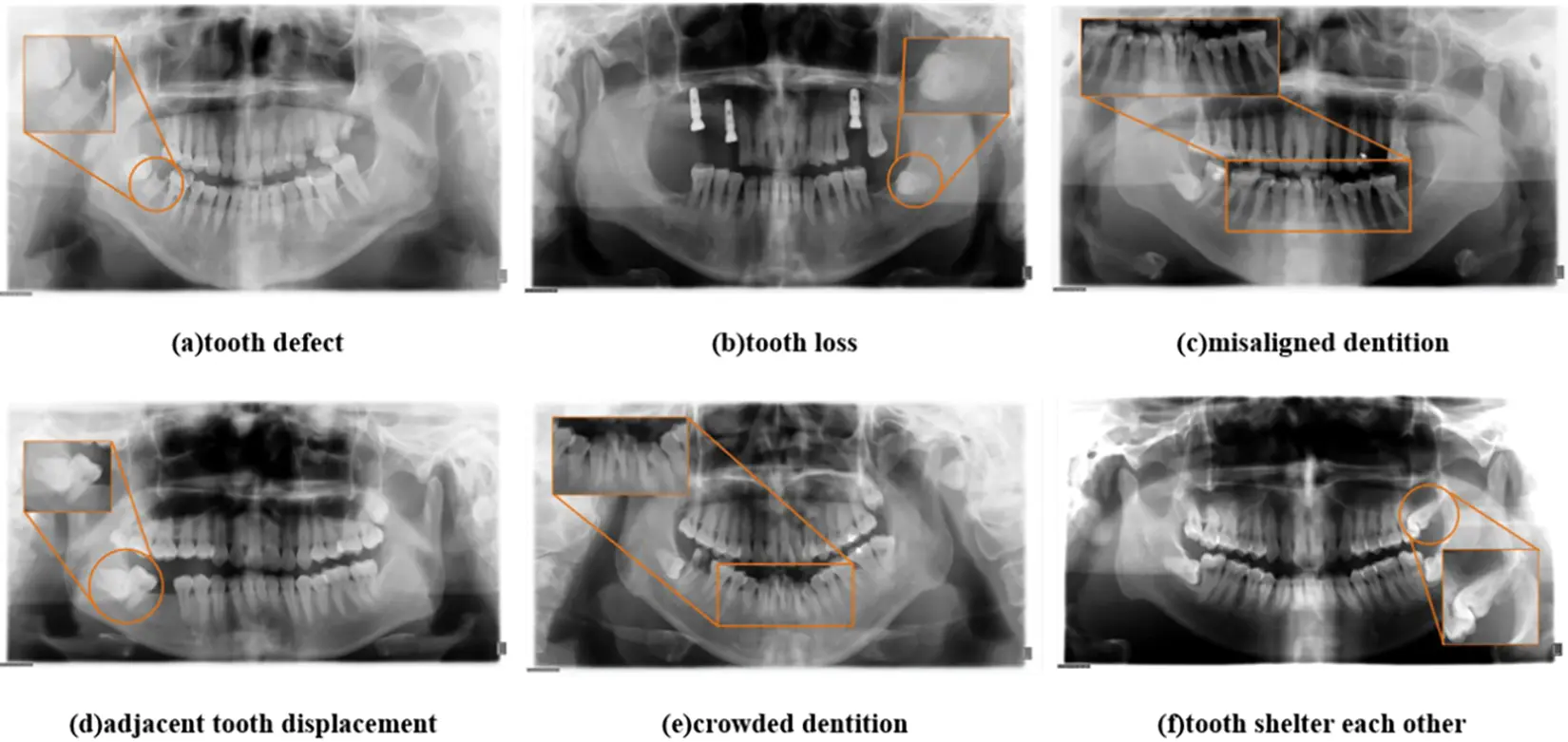 CMC | Free Full-Text | Teeth YOLACT: An Instance Segmentation Model Based on Impacted Tooth ...