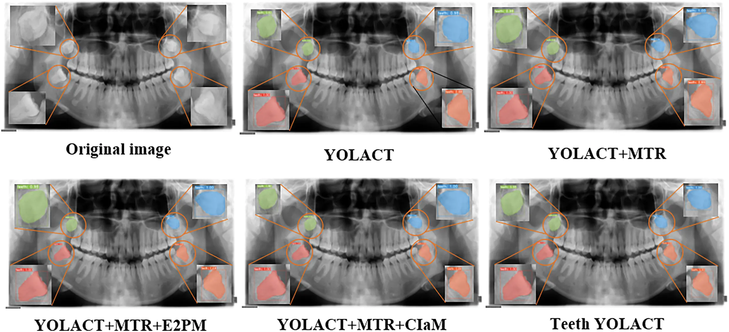 CMC | Free Full-Text | Teeth YOLACT: An Instance Segmentation Model Based on Impacted Tooth ...