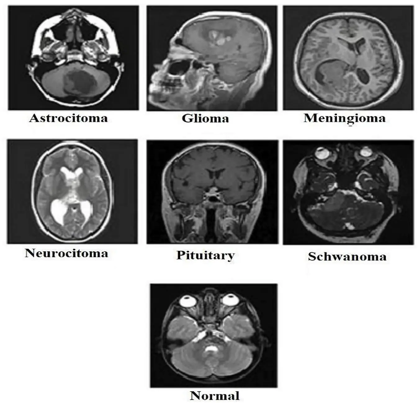 JAI | Free Full-Text | Enhanced Classification of Brain Tumor Types ...