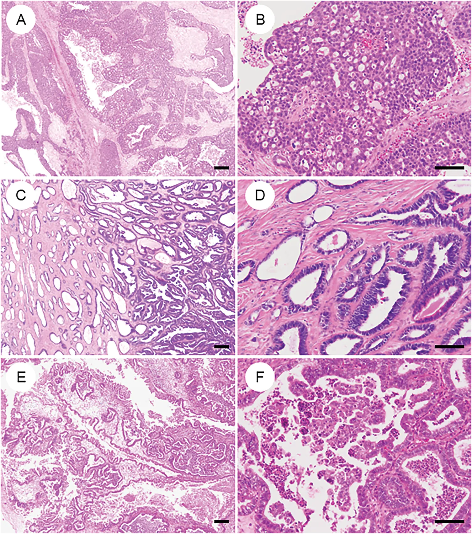 OR | Free Full-Text | Molecular Pathology of Ovarian Endometrioid Carcinoma: A Review
