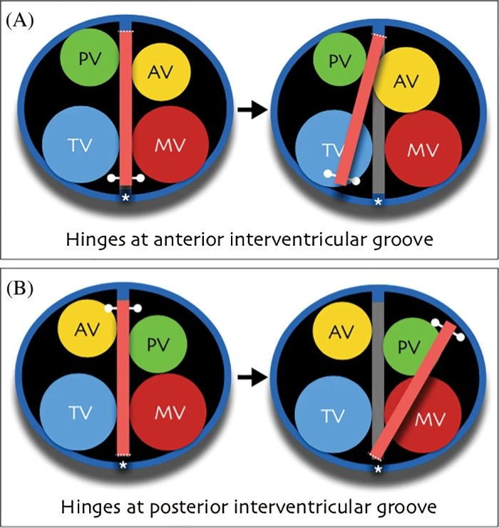 interventricular groove