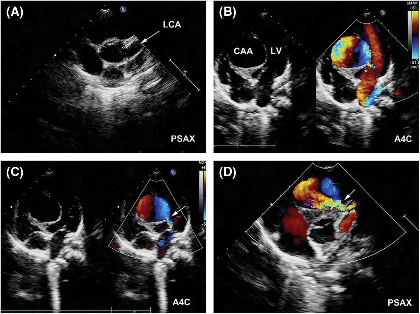 CHD | Free Full-Text | A Rare Case of Transcatheter Closure of Both ...