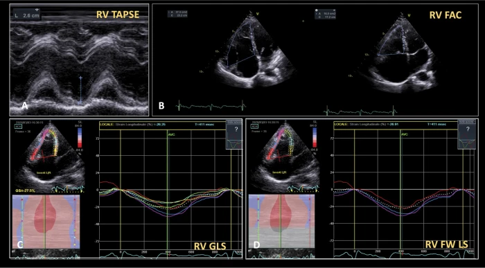 scimitar syndrome echo