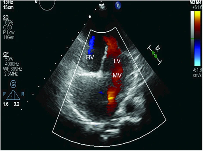 bidirectional glenn echo