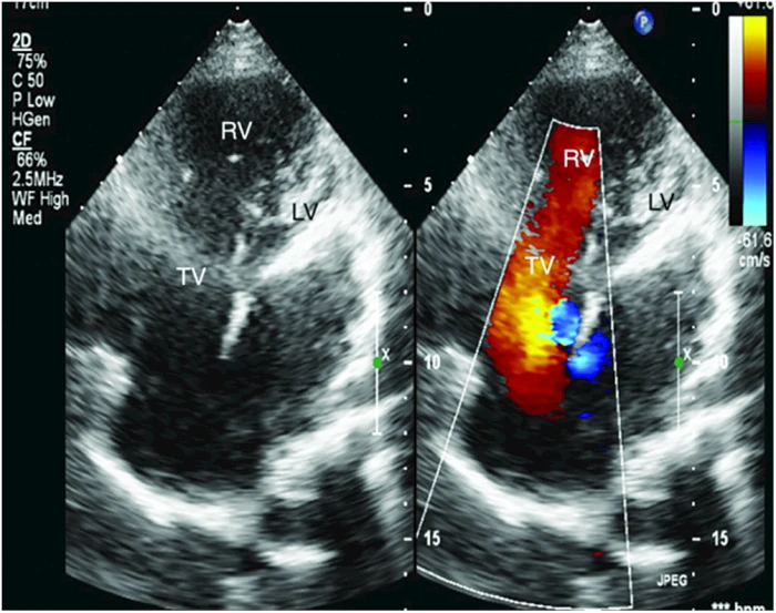 bidirectional glenn procedure steps