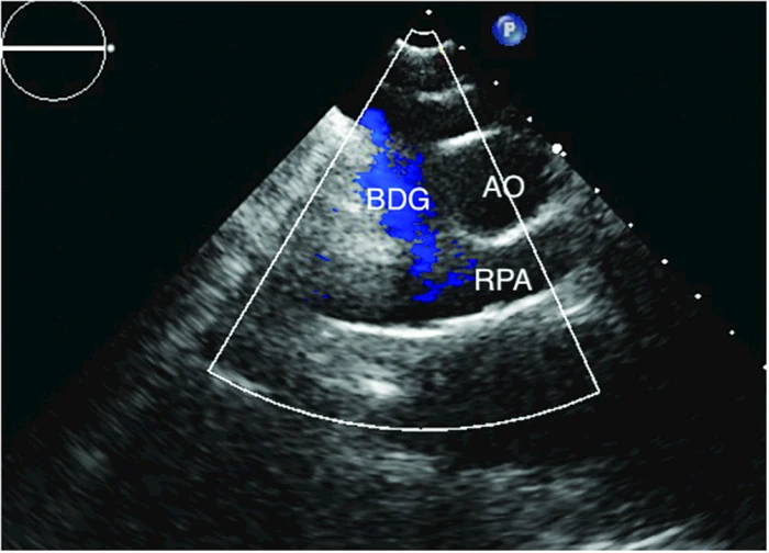 bidirectional glenn procedure