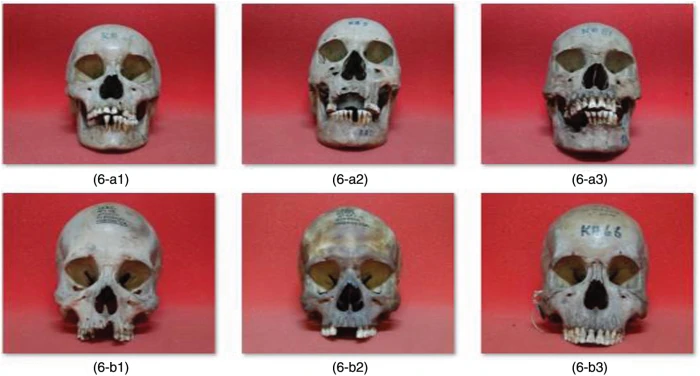 skull types