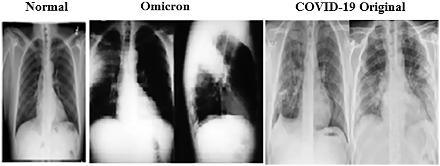 CMC | Free Full-Text | Detection of Omicron Caused Pneumonia from Radiology Images Using ...