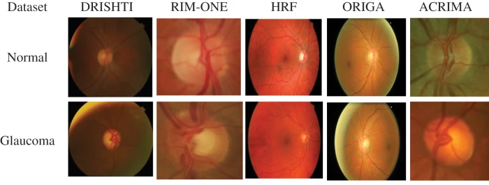glaucoma oct dataset